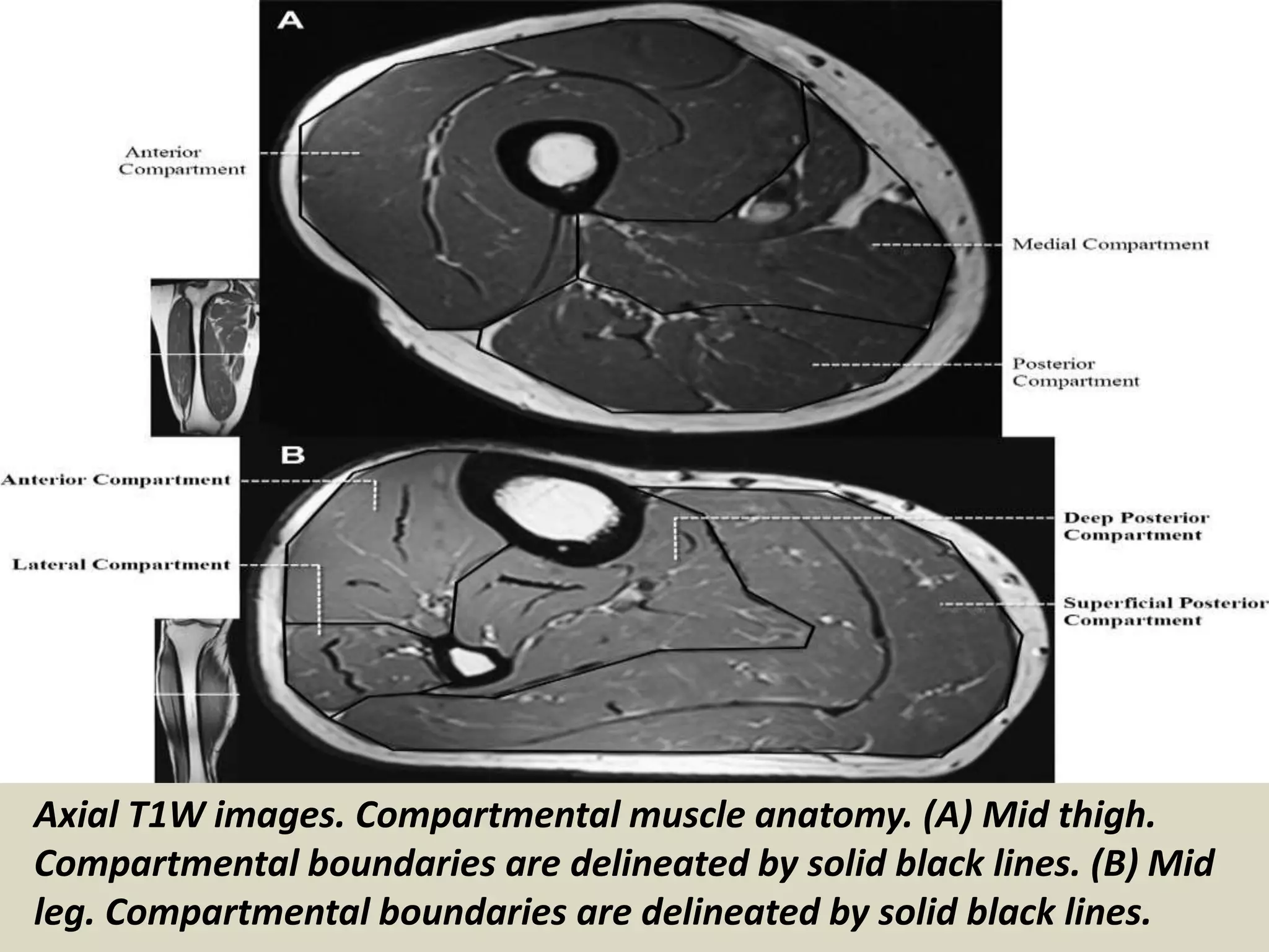 Presentation1.pptx, radiological anatomy of the thigh and leg. | PPTX