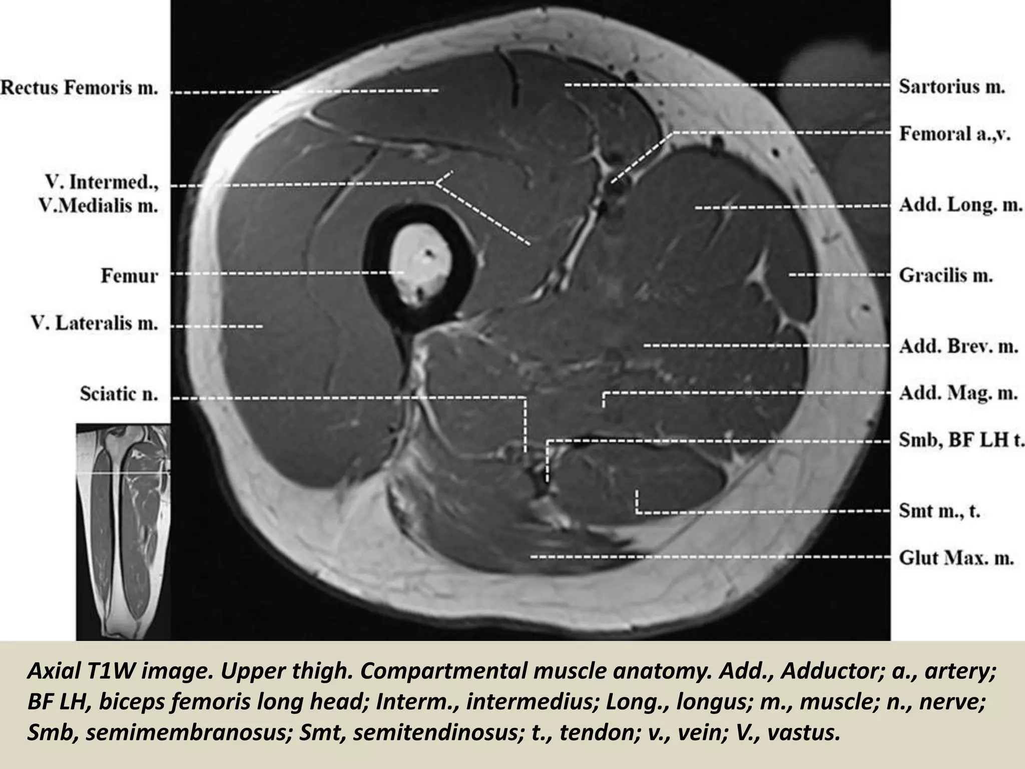 Presentation1.pptx, radiological anatomy of the thigh and leg. | PPTX