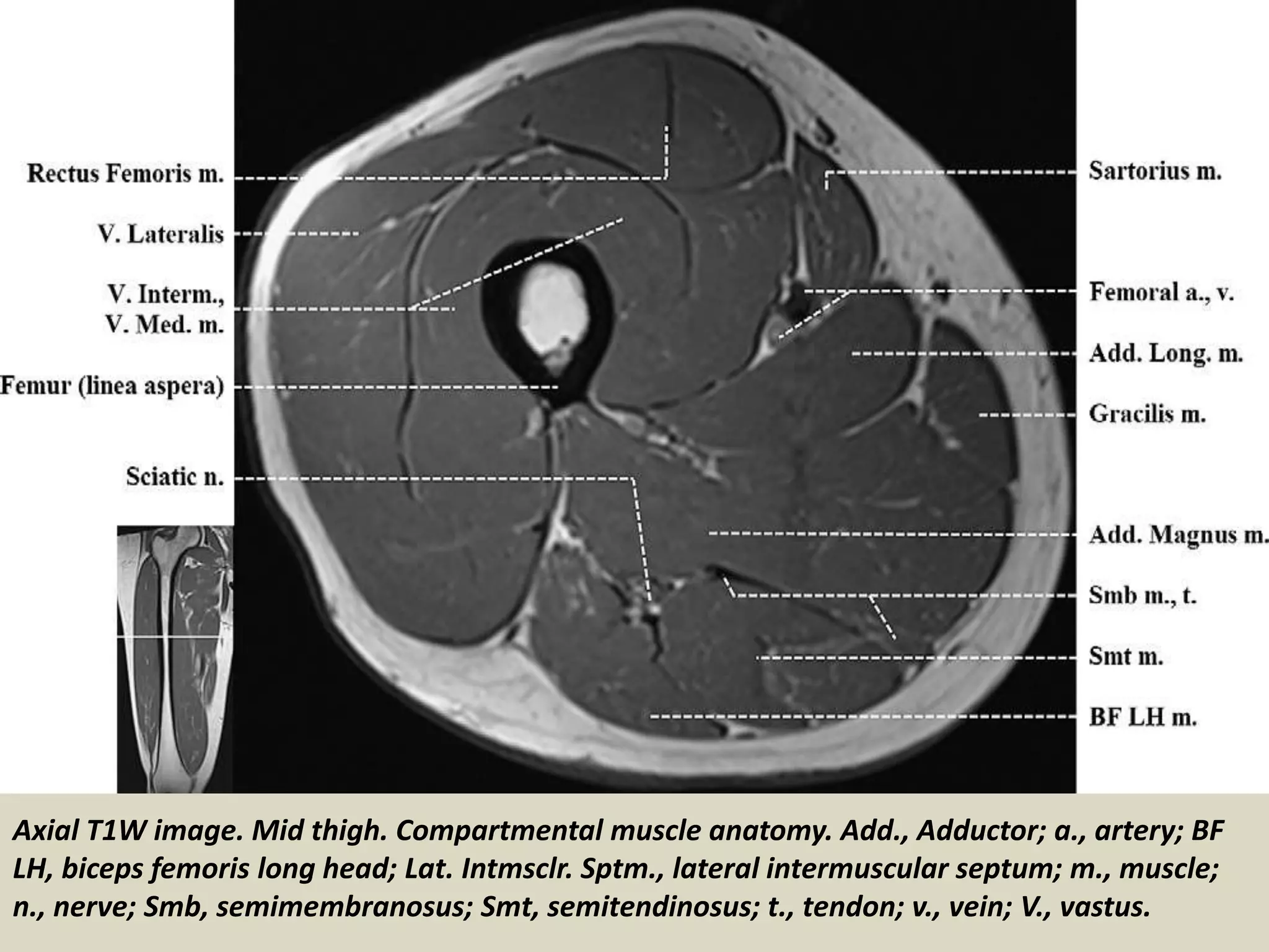 Presentation1.pptx, radiological anatomy of the thigh and leg. | PPTX