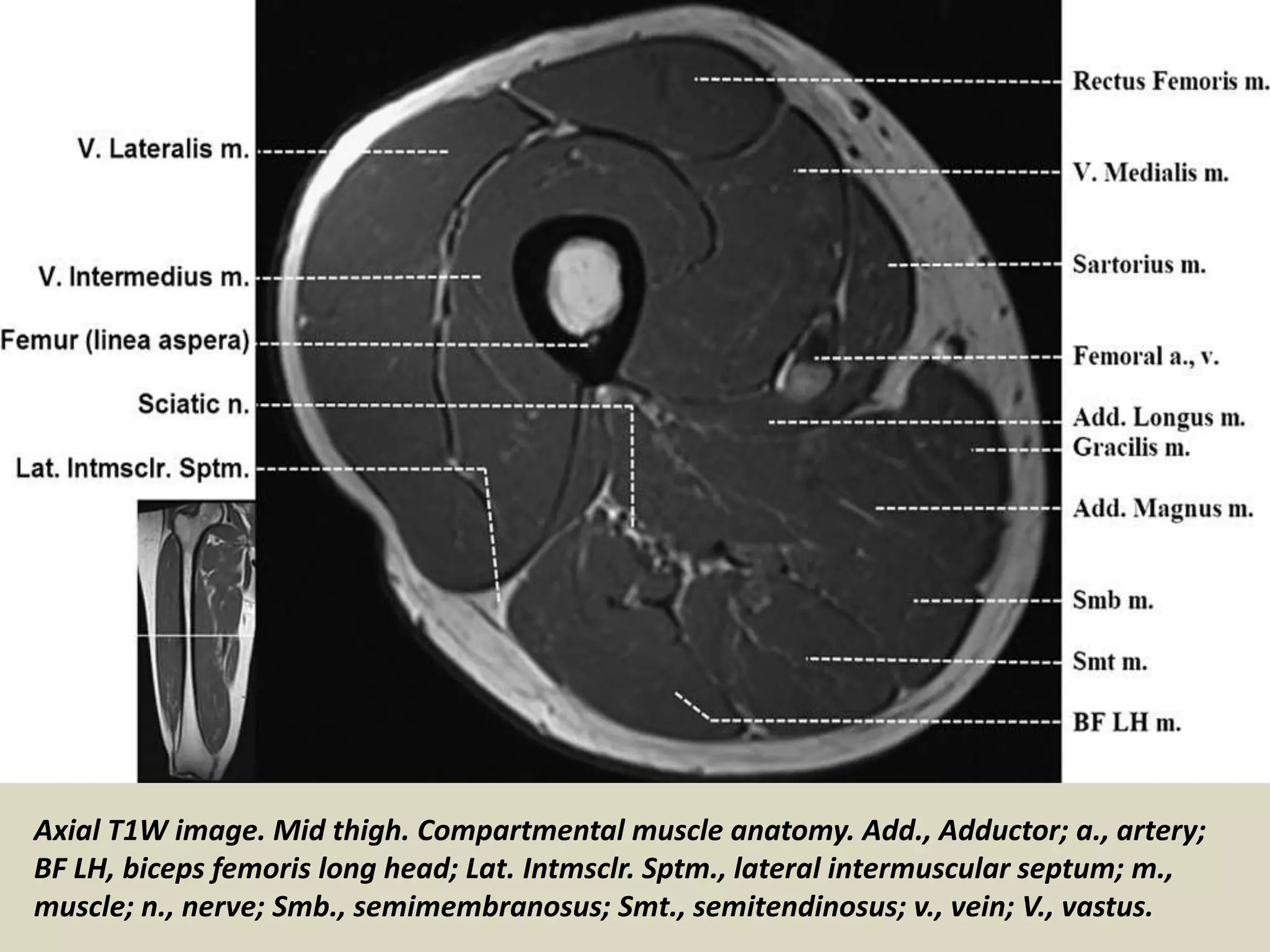 Presentation1.pptx, radiological anatomy of the thigh and leg. | PPTX