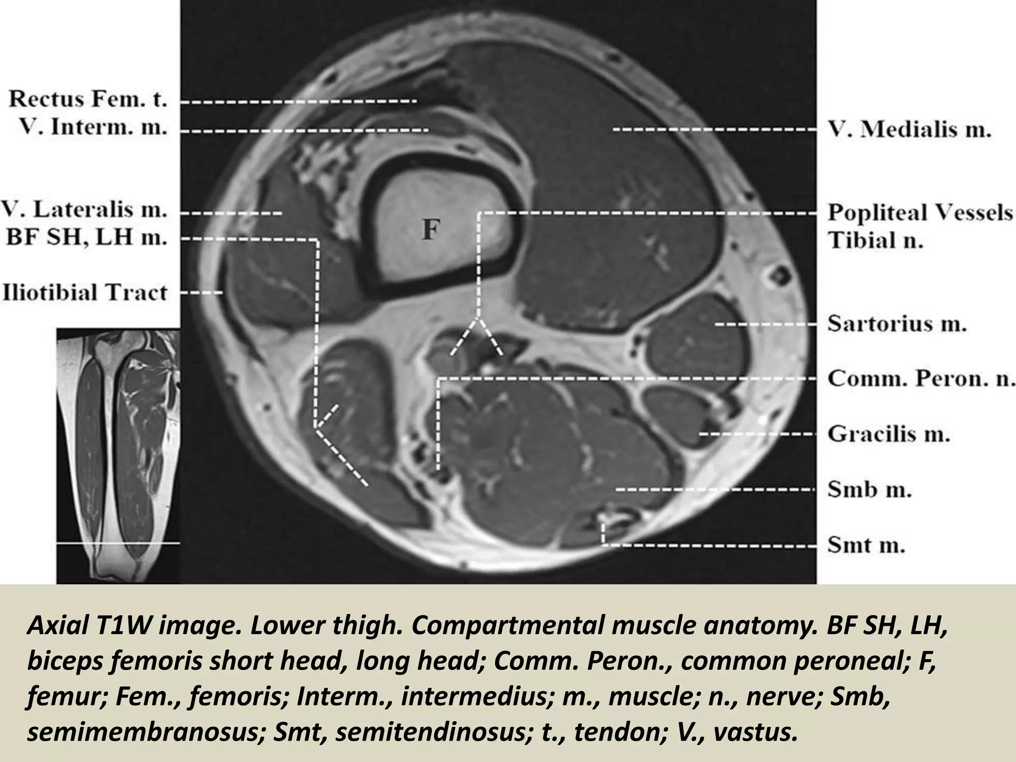 Presentation1.pptx, radiological anatomy of the thigh and leg. | PPTX