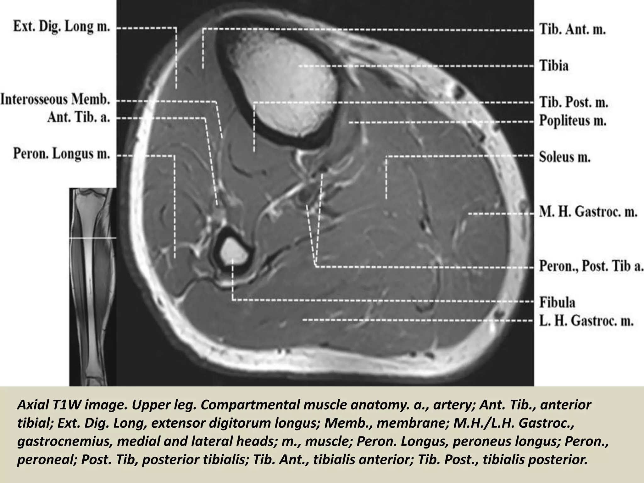 Presentation1.pptx, radiological anatomy of the thigh and leg. | PPTX