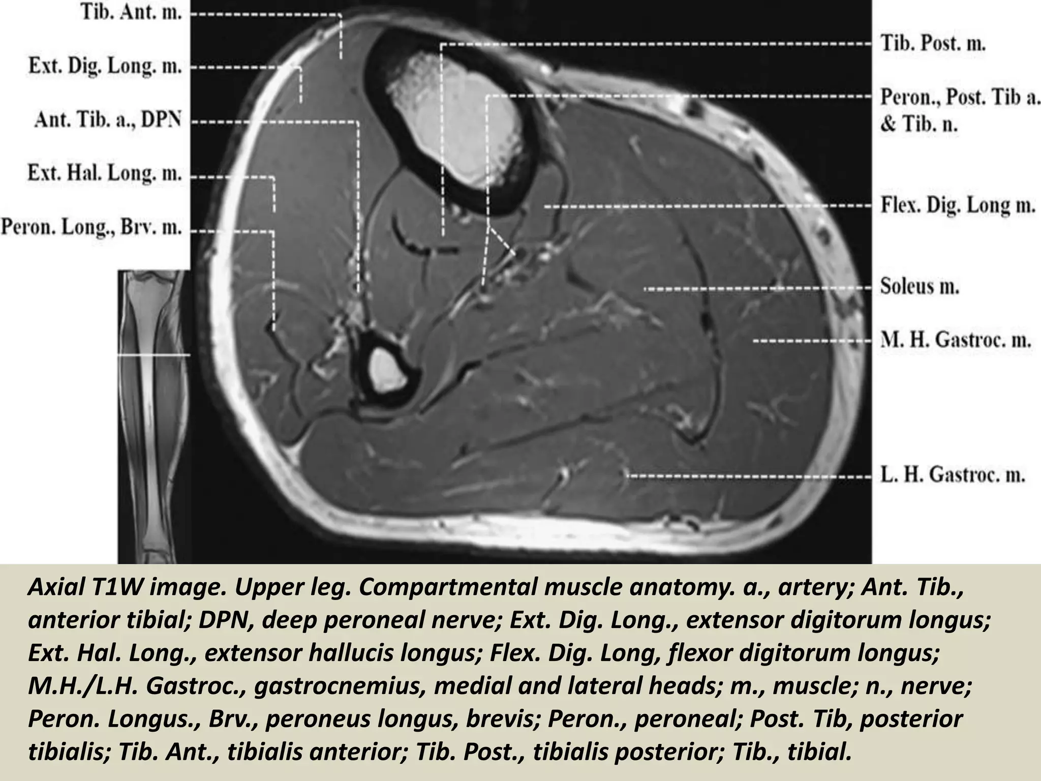 Presentation1.pptx, radiological anatomy of the thigh and leg. | PPTX