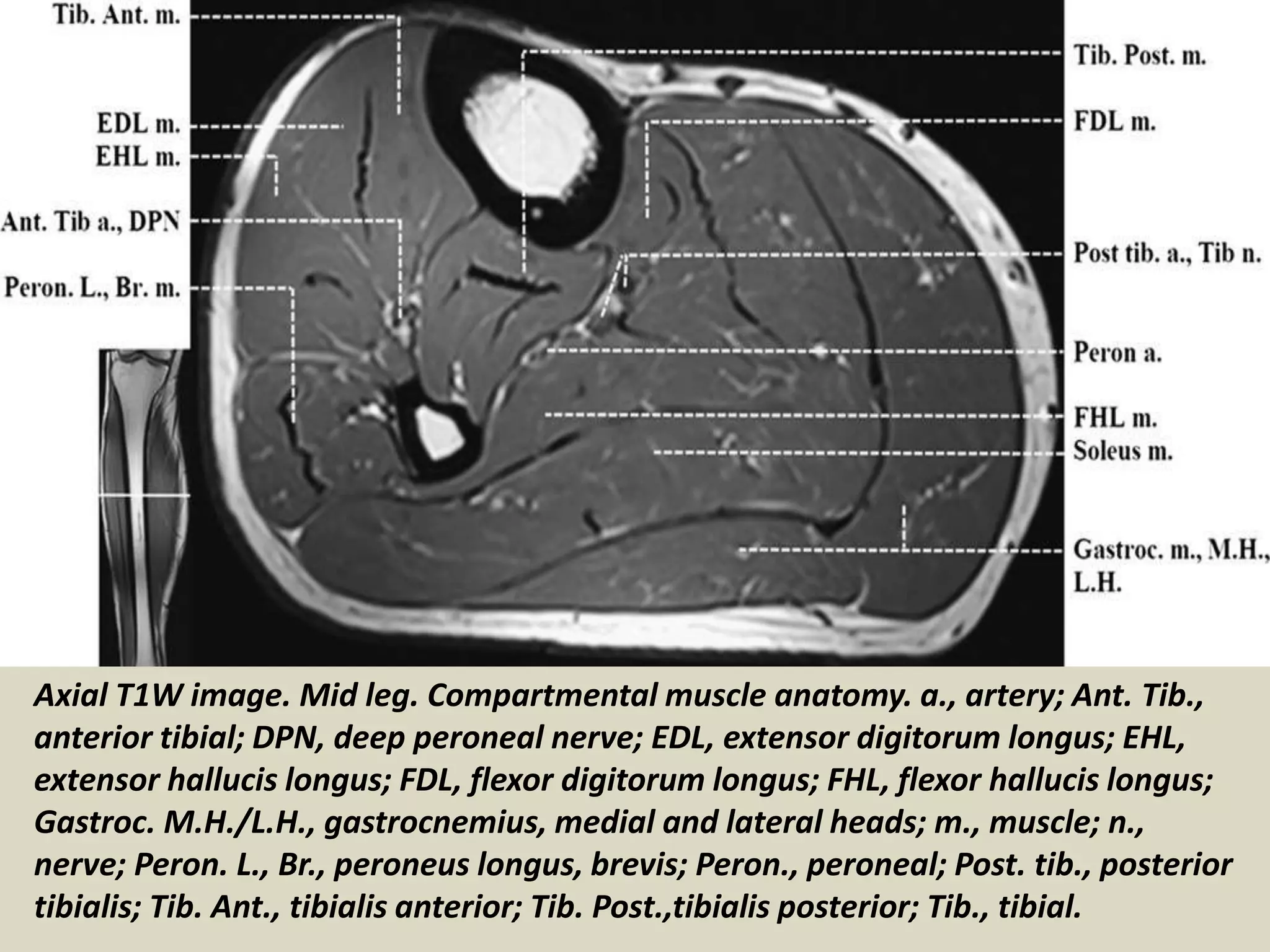 Presentation1.pptx, radiological anatomy of the thigh and leg. | PPTX