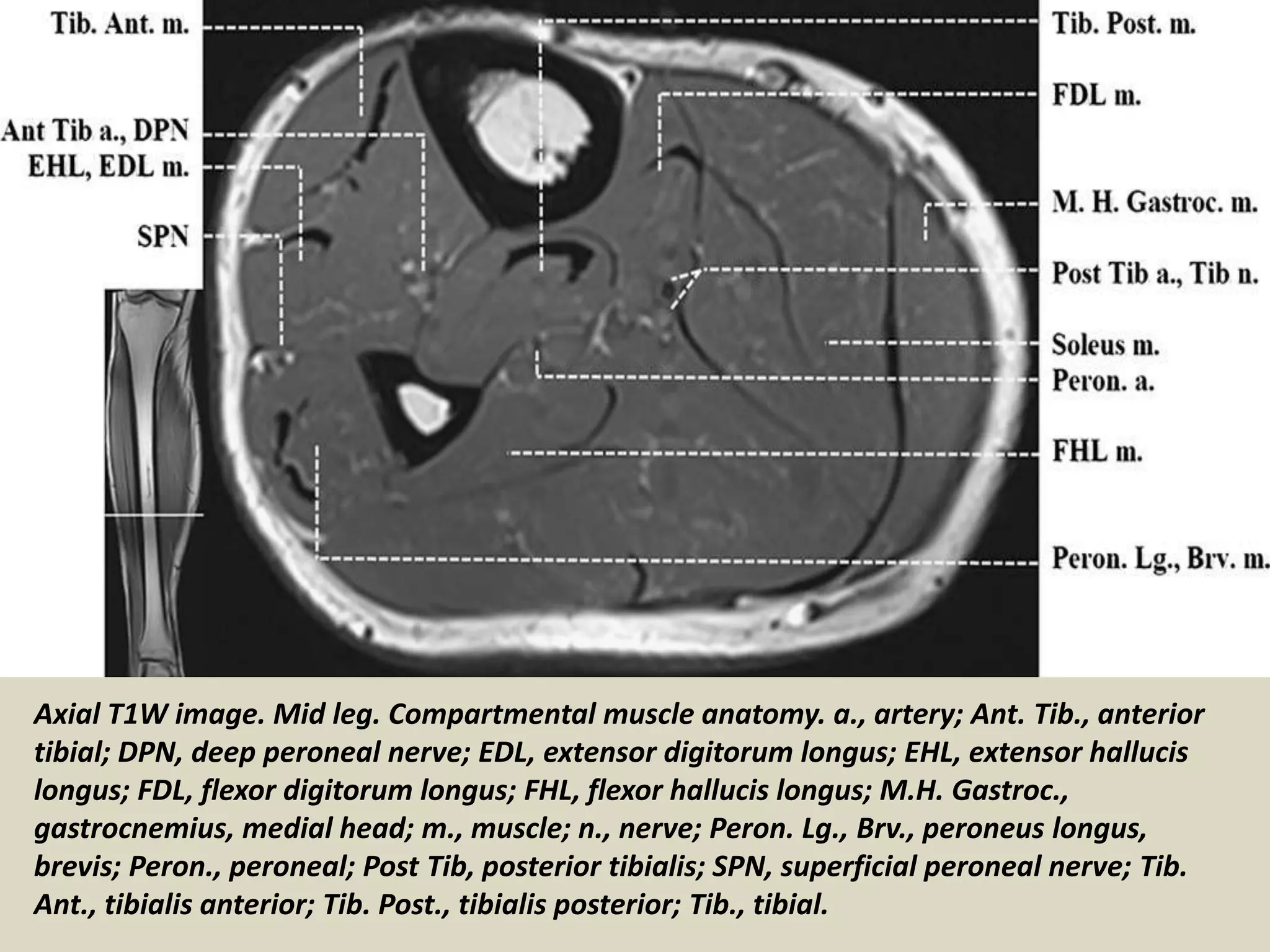 Presentation1.pptx, radiological anatomy of the thigh and leg. | PPTX