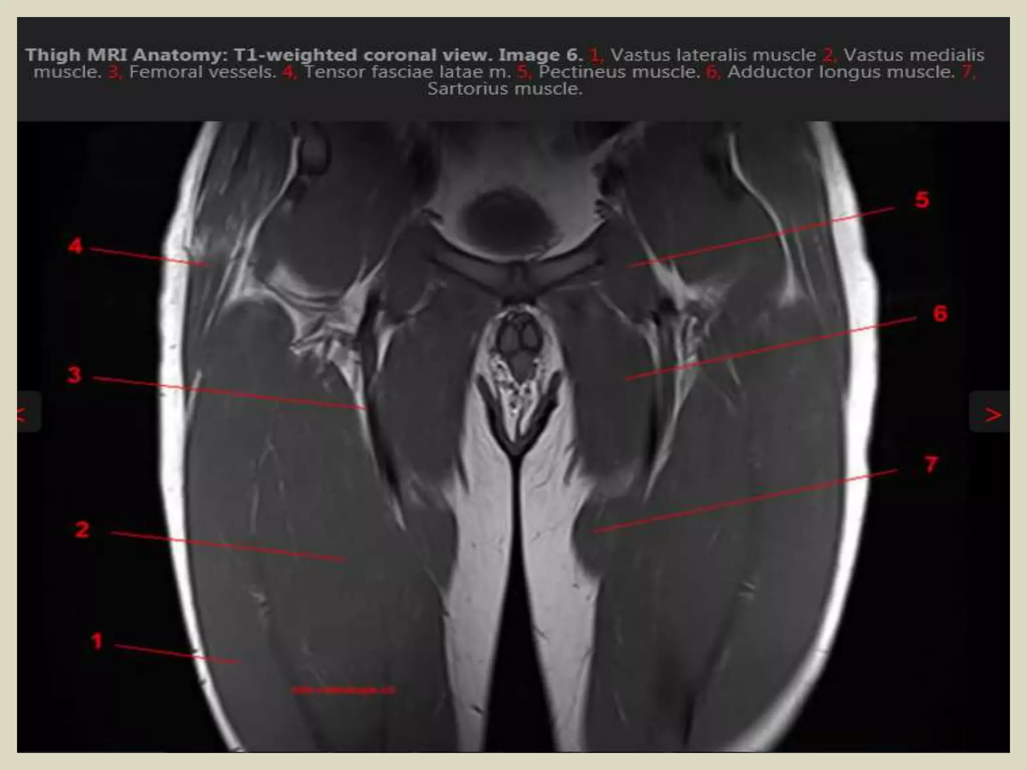 Presentation1.pptx, radiological anatomy of the thigh and leg. | PPTX