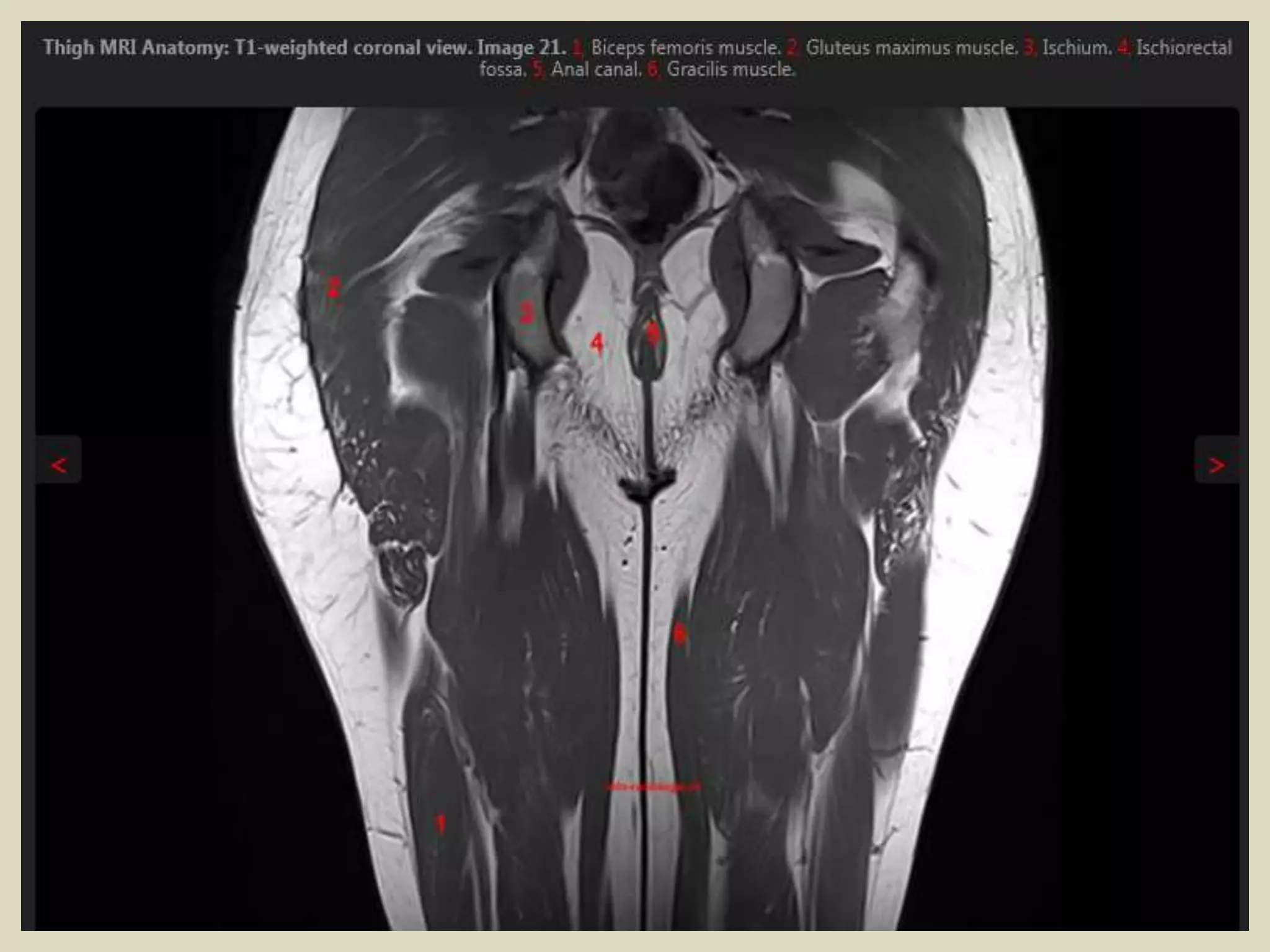 Presentation1.pptx, radiological anatomy of the thigh and leg. | PPTX