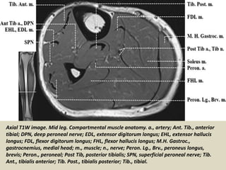 Presentation1.pptx, radiological anatomy of the thigh and leg. | PPTX