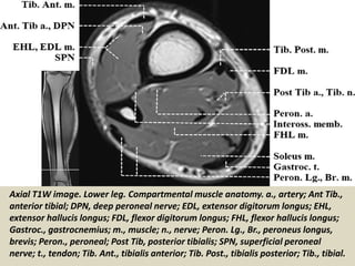 Presentation1.pptx, radiological anatomy of the thigh and leg. | PPTX
