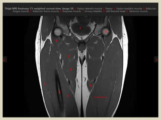 Presentation1.pptx, radiological anatomy of the thigh and leg. | PPTX
