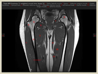 Presentation1.pptx, radiological anatomy of the thigh and leg. | PPTX