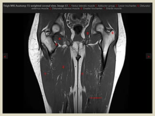 Presentation1.pptx, radiological anatomy of the thigh and leg. | PPTX