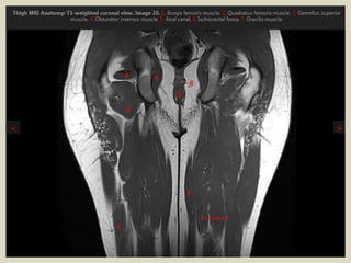Presentation1.pptx, radiological anatomy of the thigh and leg. | PPTX
