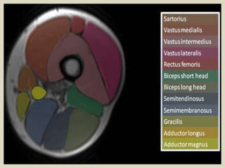 Pectineus Muscle Axial