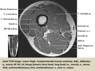 Pectineus Muscle Axial