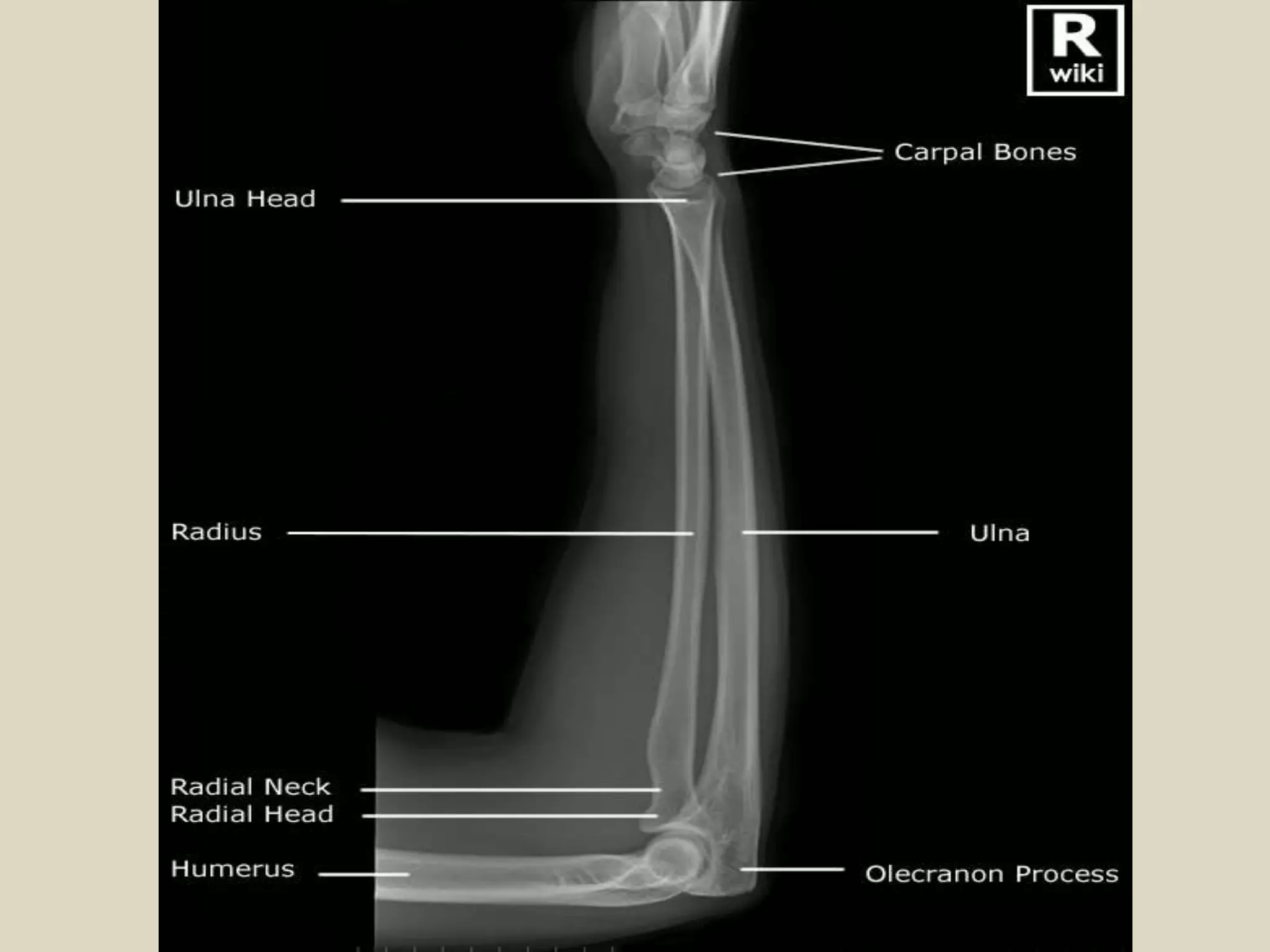 Presentation1.pptx, radiological anatomy of the arm and forearm. | PPTX
