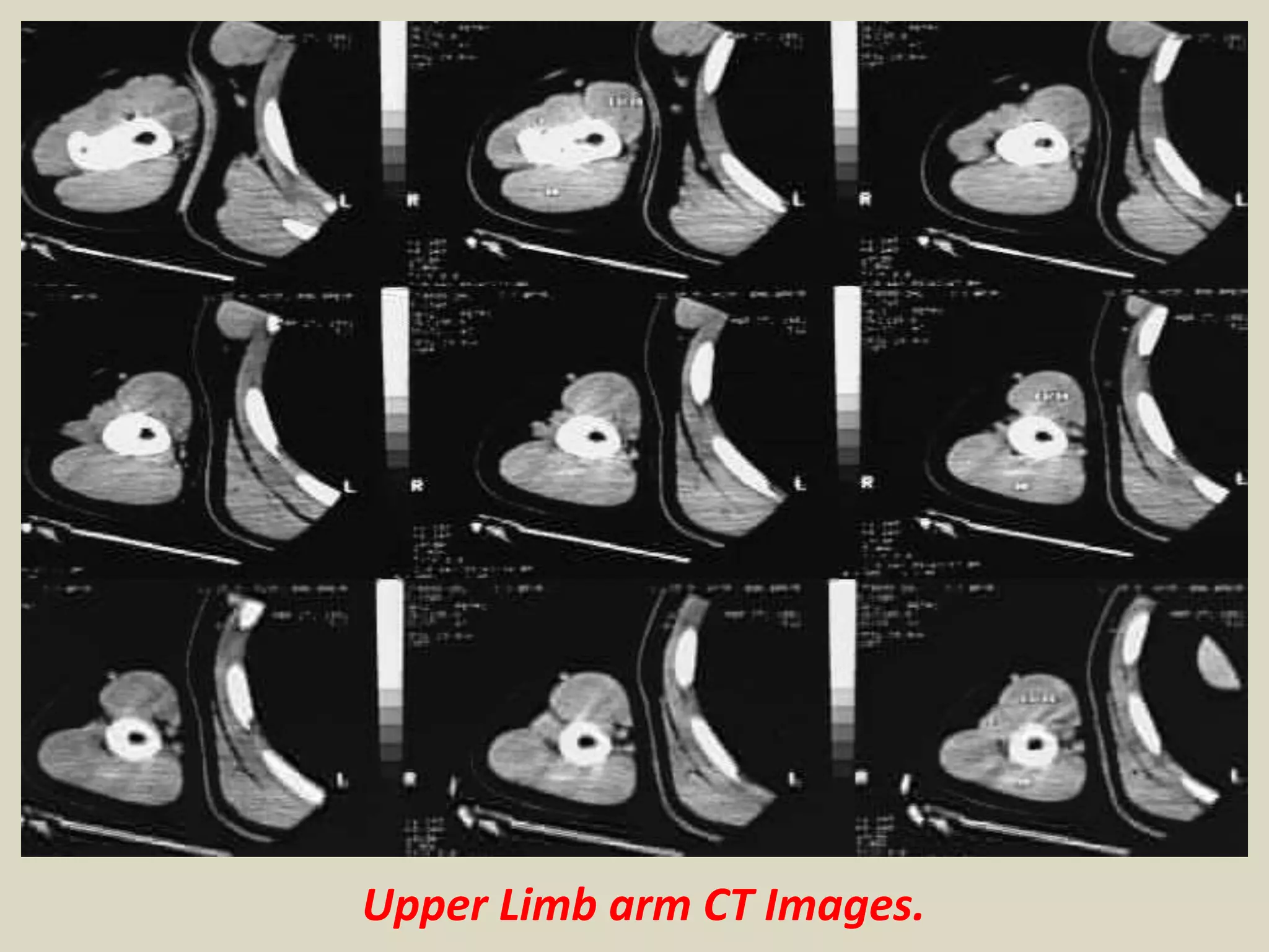 Presentation1.pptx, radiological anatomy of the arm and forearm. | PPTX