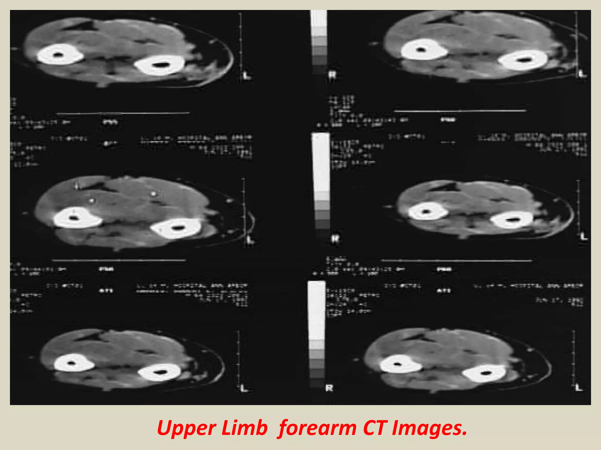 Presentation1.pptx, radiological anatomy of the arm and forearm. | PPTX