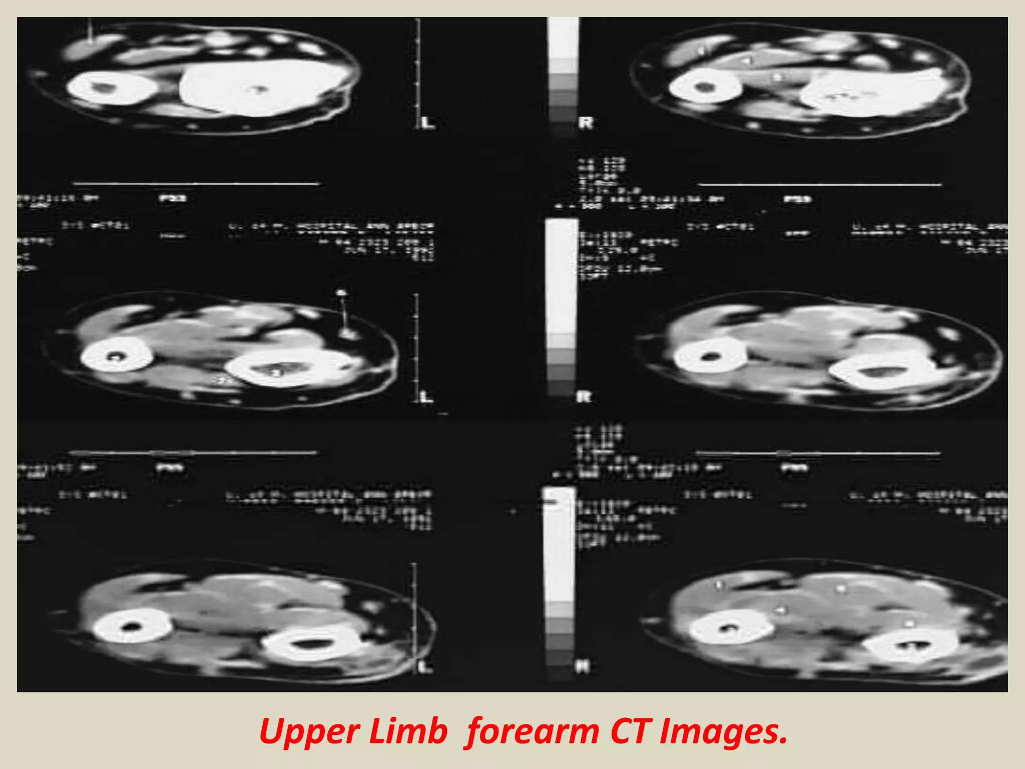 Presentation1.pptx, radiological anatomy of the arm and forearm. | PPTX