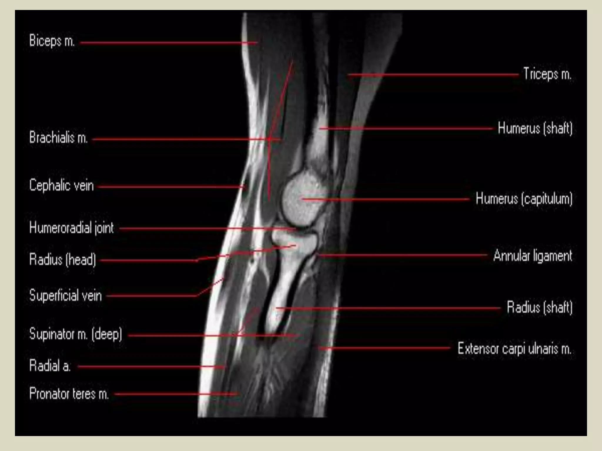 Presentation1.pptx, radiological anatomy of the arm and forearm. | PPTX