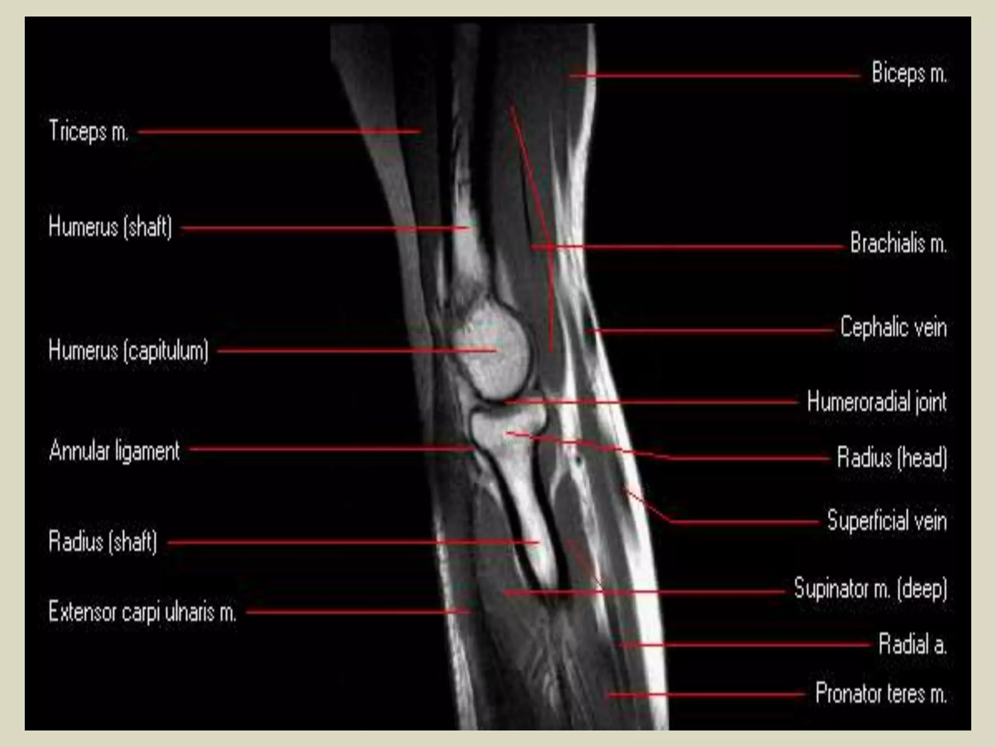 Presentation1.pptx, radiological anatomy of the arm and forearm. | PPTX