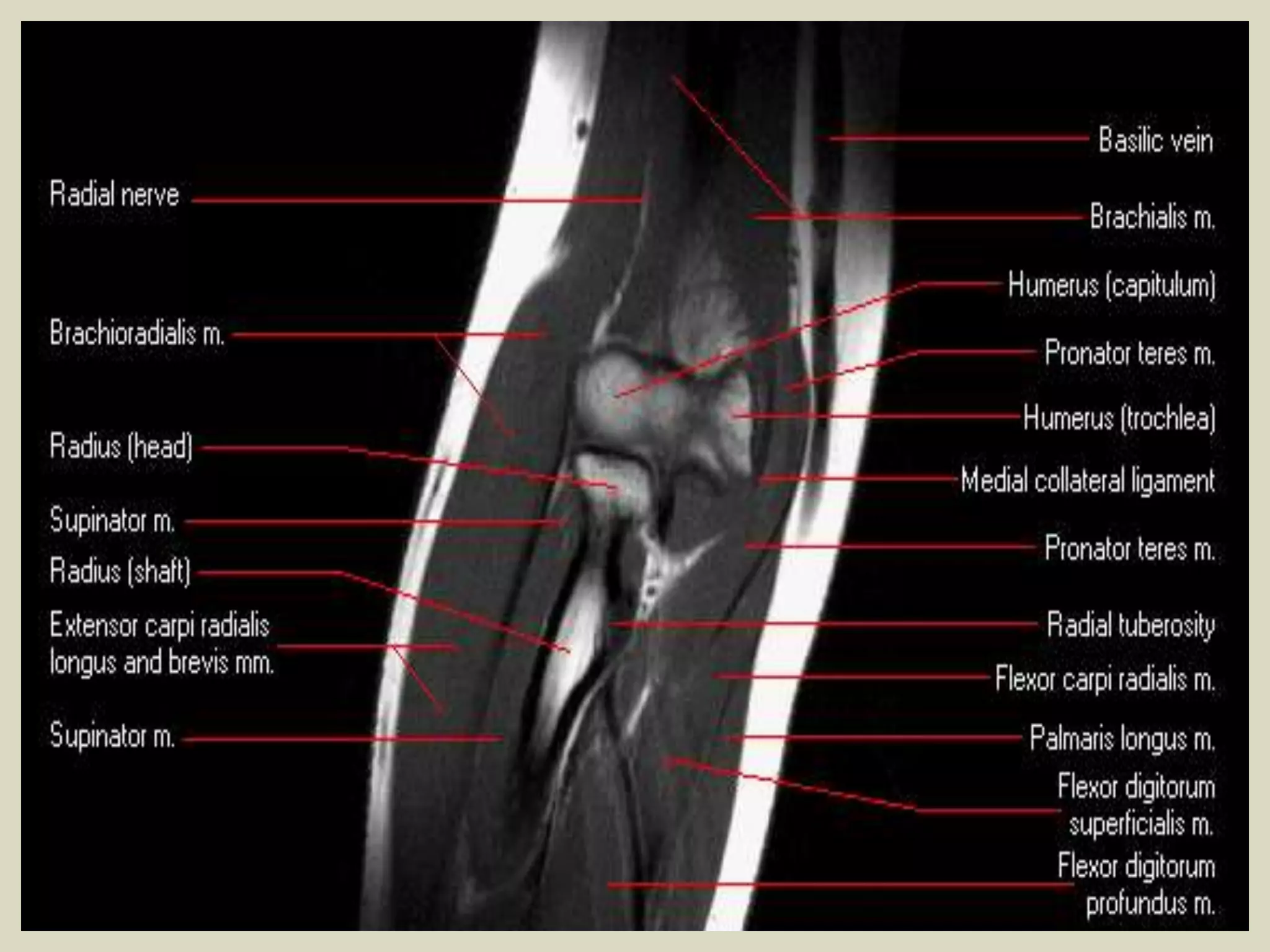 Presentation1.pptx, radiological anatomy of the arm and forearm. | PPTX