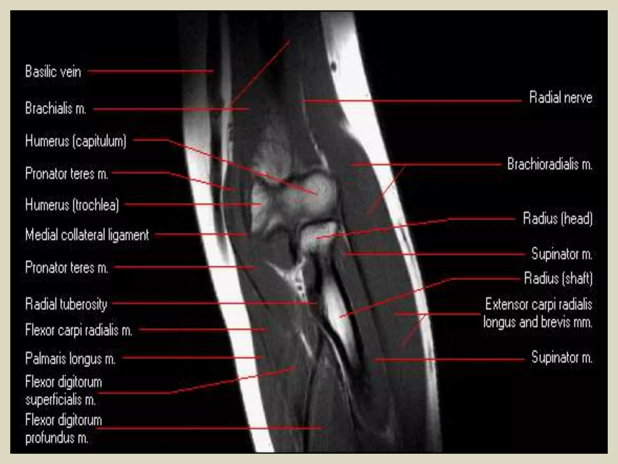 Presentation1.pptx, radiological anatomy of the arm and forearm. | PPTX