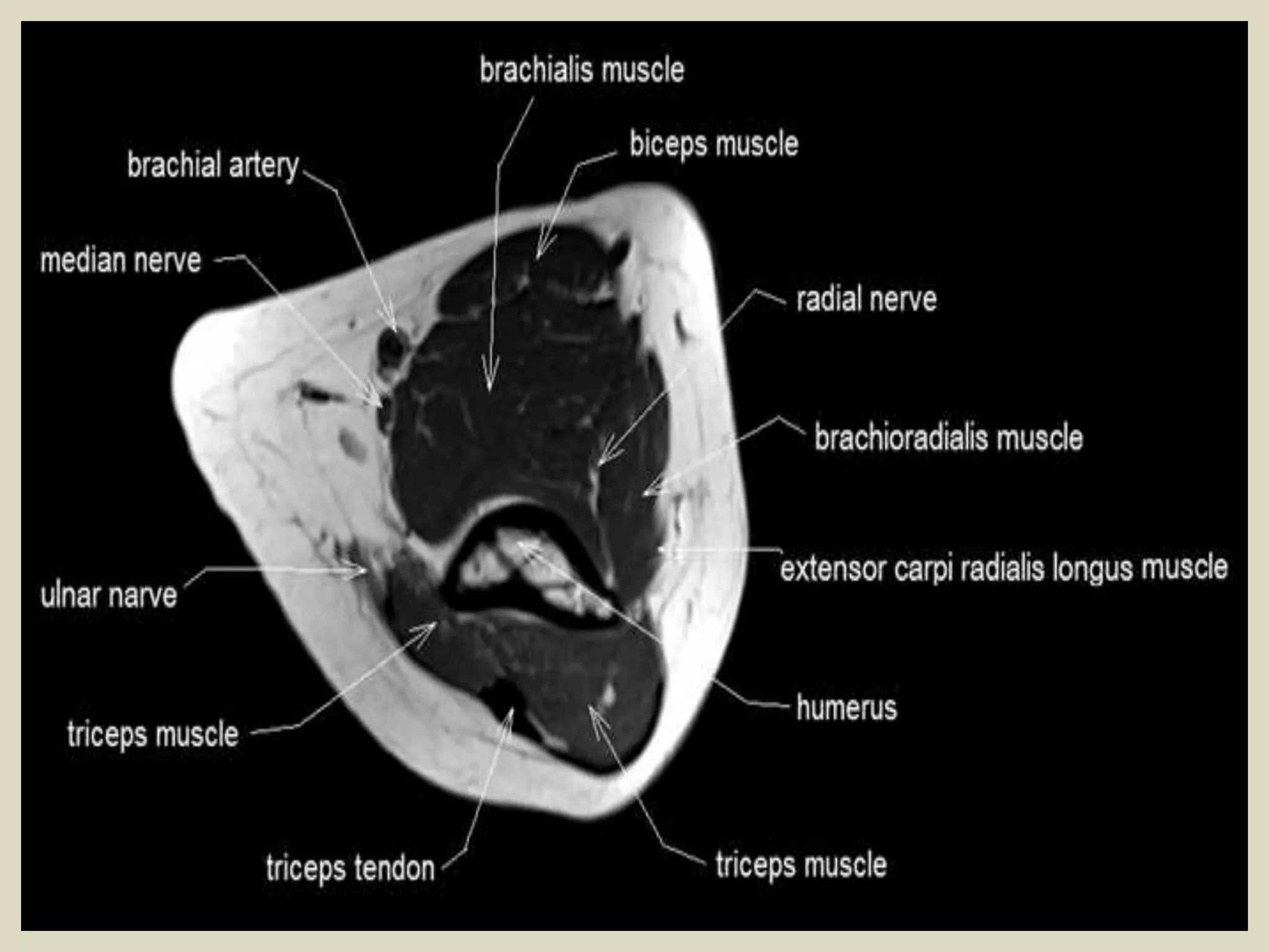 Presentation1.pptx, radiological anatomy of the arm and forearm. | PPTX