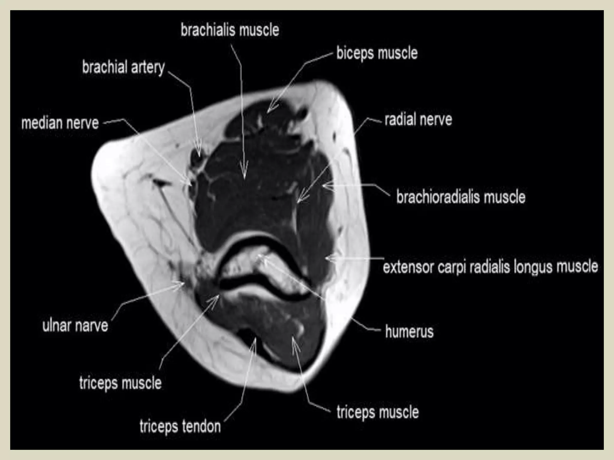 Presentation1.pptx, radiological anatomy of the arm and forearm. | PPTX