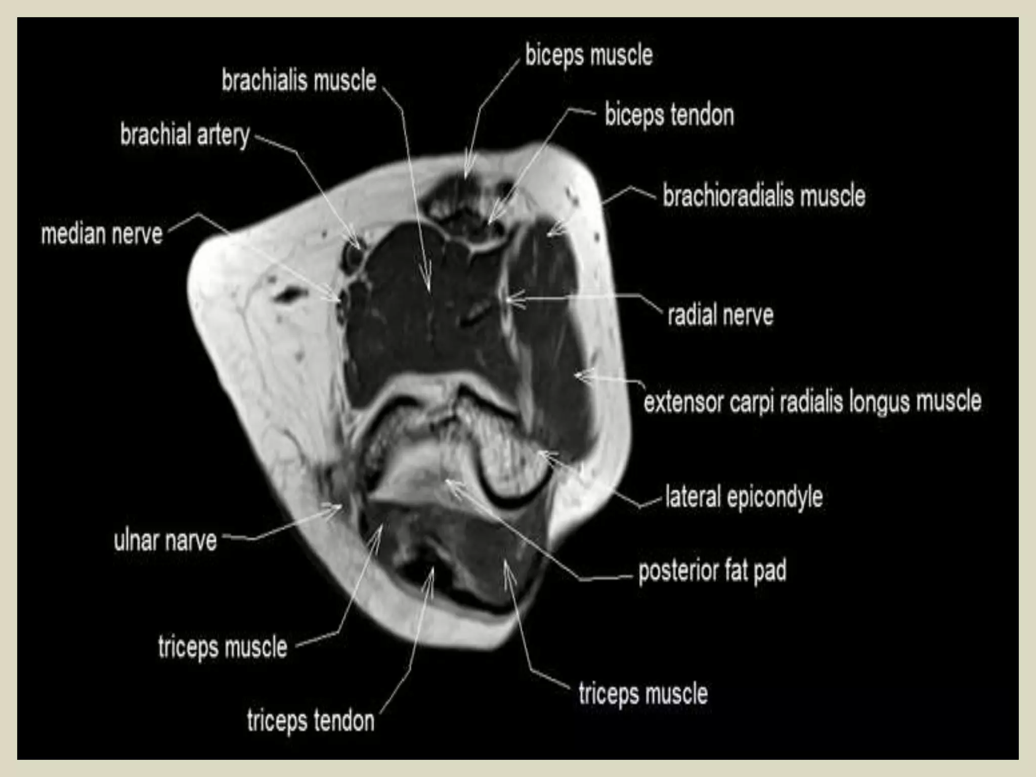 Presentation1.pptx, radiological anatomy of the arm and forearm. | PPTX