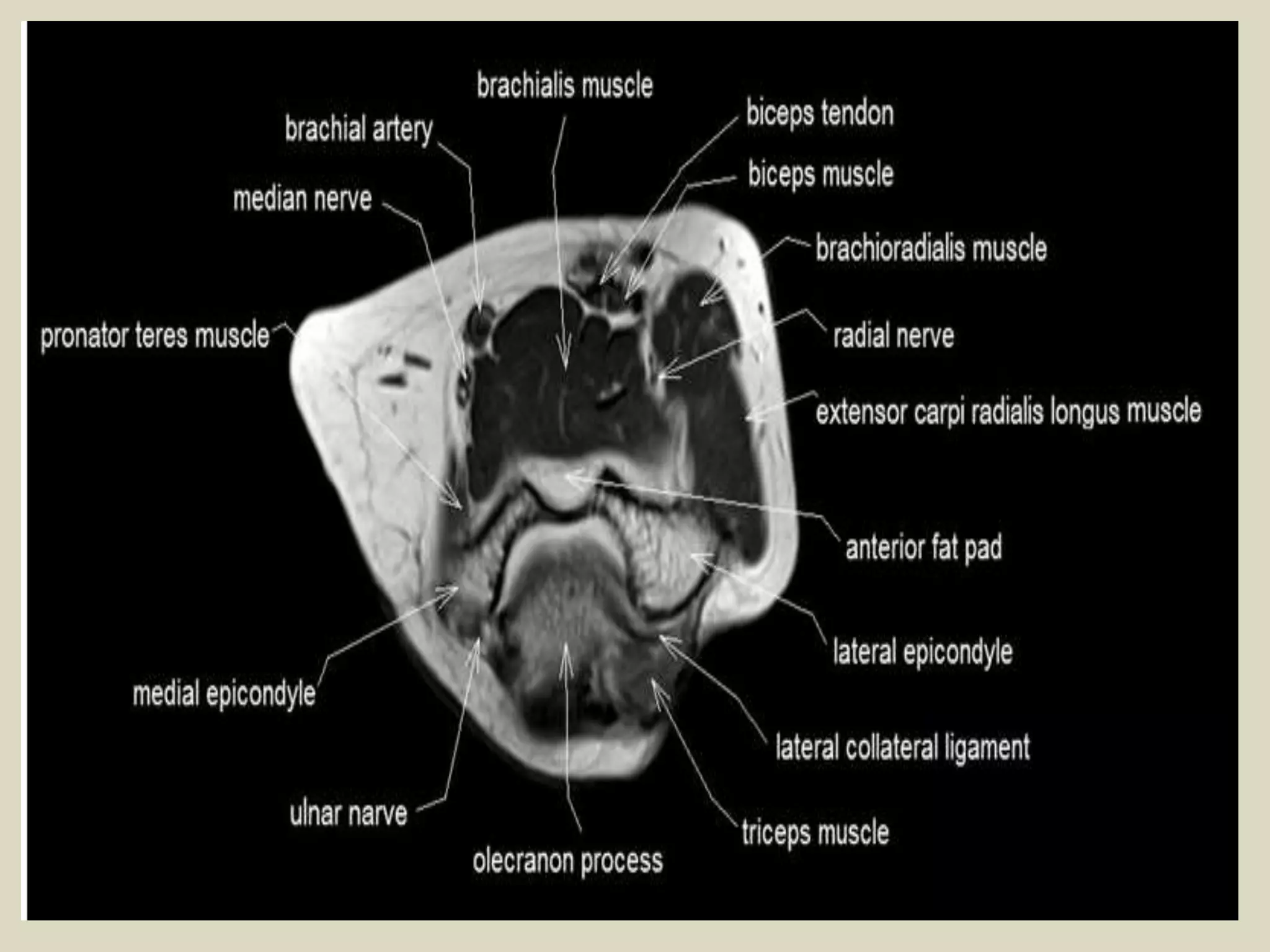 Presentation1.pptx, radiological anatomy of the arm and forearm. | PPTX