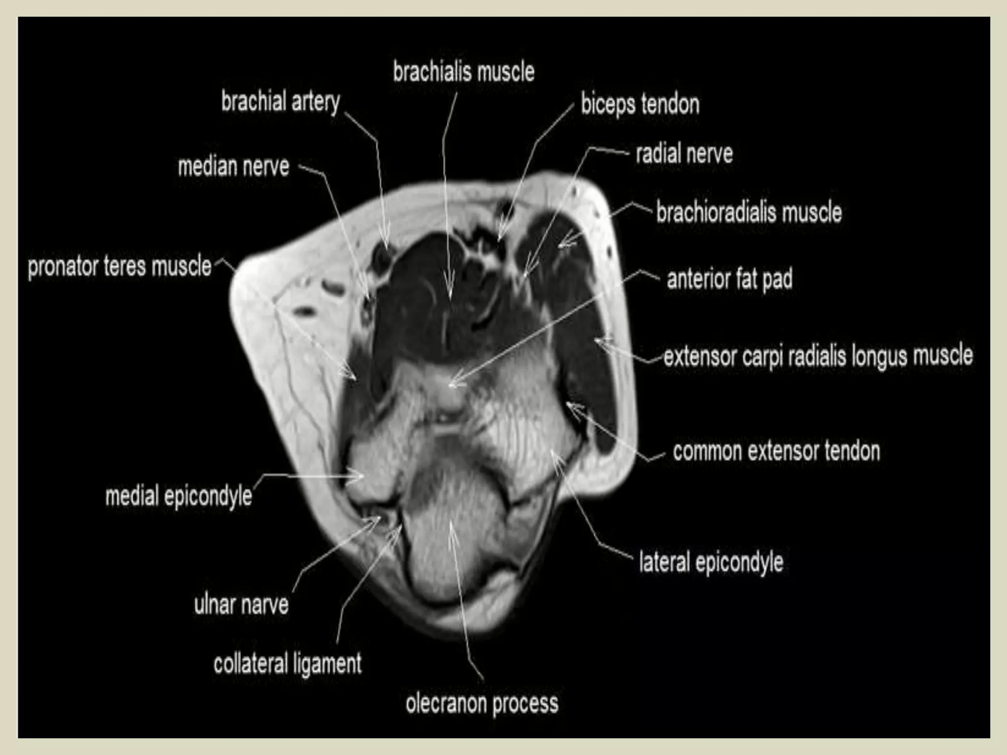 Presentation1.pptx, radiological anatomy of the arm and forearm. | PPTX