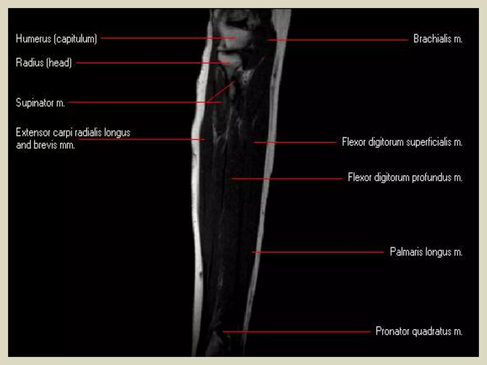 Presentation1.pptx, radiological anatomy of the arm and forearm. | PPTX