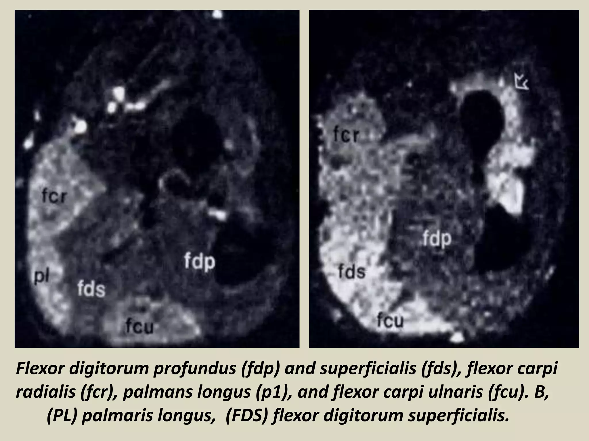 Presentation1.pptx, radiological anatomy of the arm and forearm. | PPTX