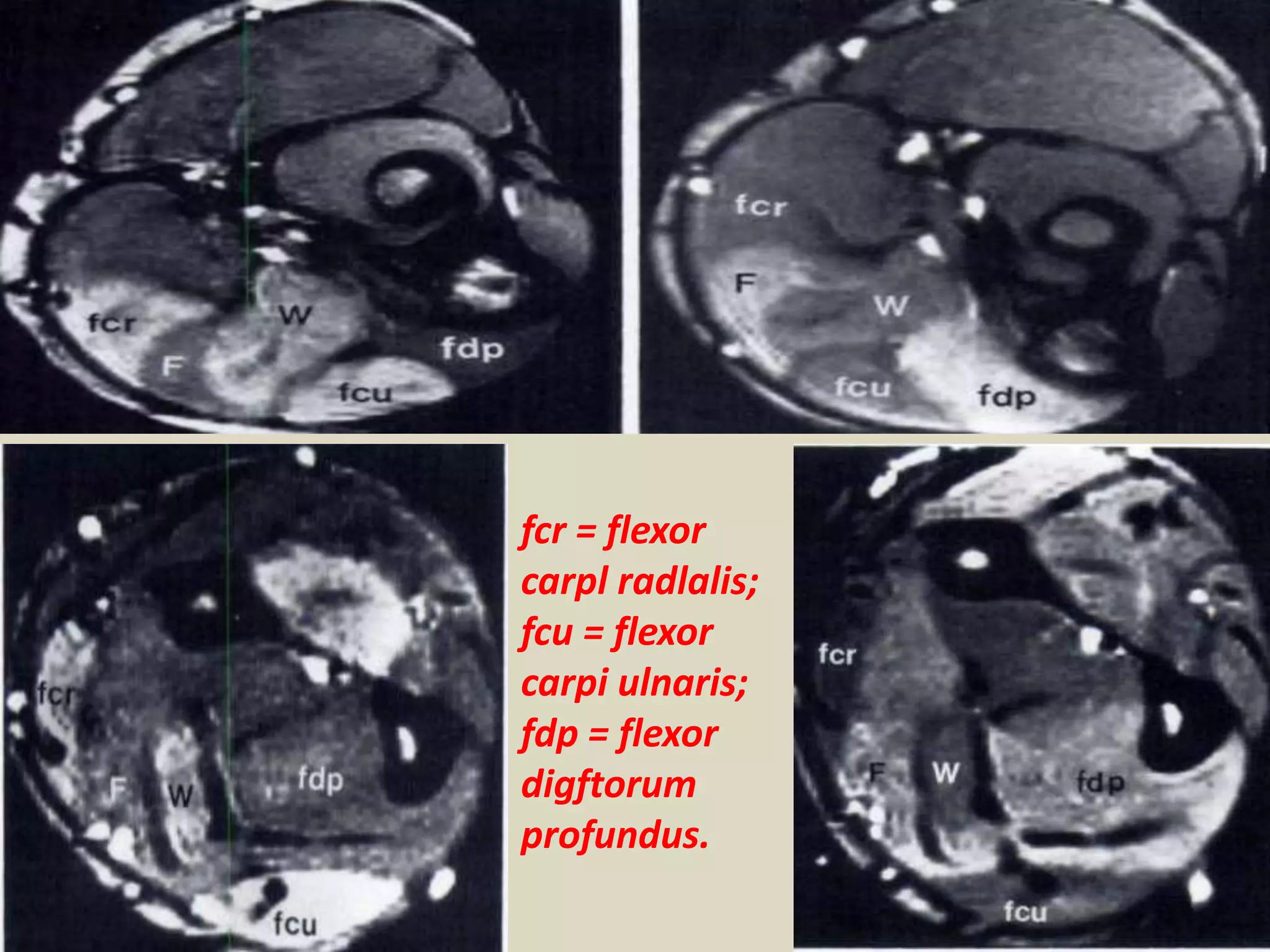 Presentation1.pptx, radiological anatomy of the arm and forearm. | PPTX