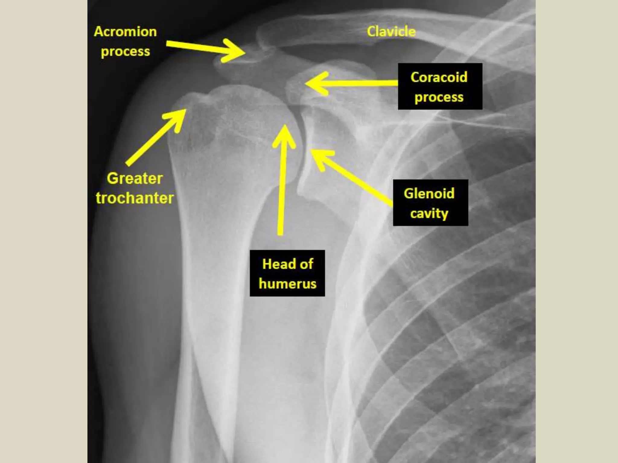 Presentation1.pptx, radiological anatomy of the arm and forearm. | PPTX