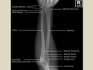 Presentation1.pptx, radiological anatomy of the arm and forearm. | PPT