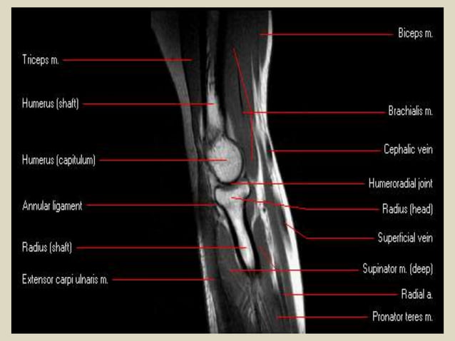 Presentation1.pptx, radiological anatomy of the arm and forearm.