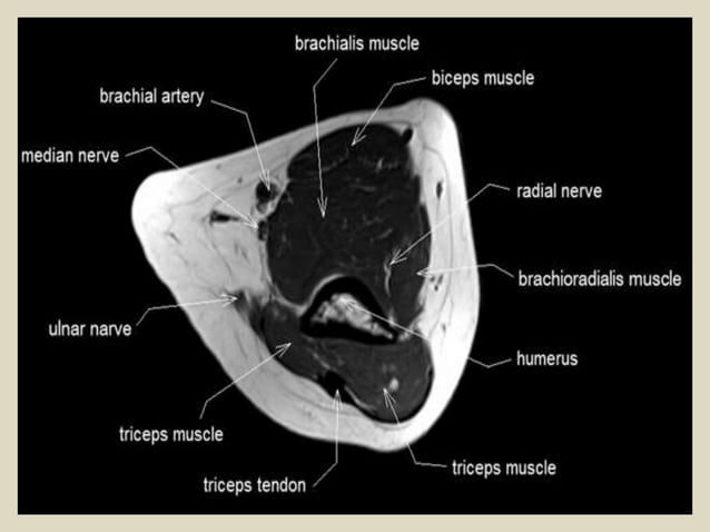 Presentation1.pptx, radiological anatomy of the arm and forearm.