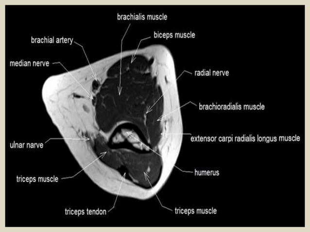 Presentation1.pptx, radiological anatomy of the arm and forearm.