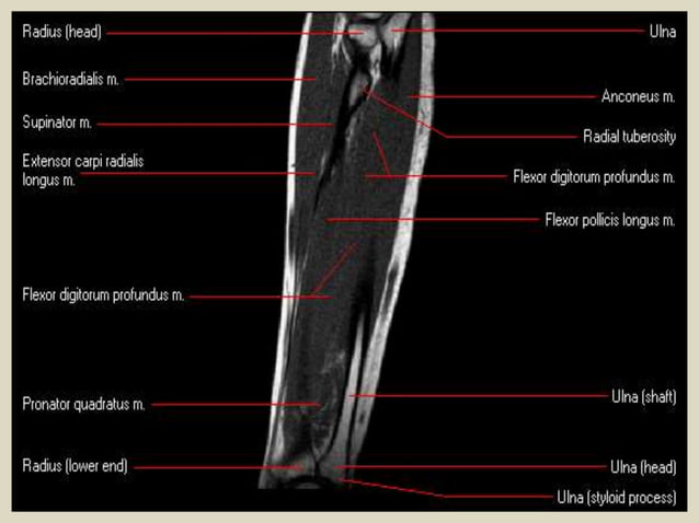 Presentation1.pptx, radiological anatomy of the arm and forearm.