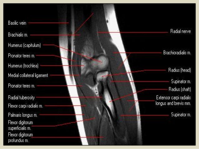 Presentation1.pptx, radiological anatomy of the arm and forearm.