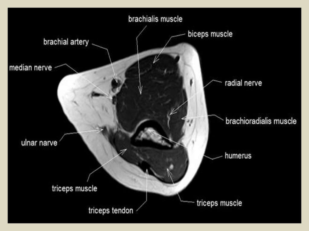 Presentation1.pptx, radiological anatomy of the arm and forearm.