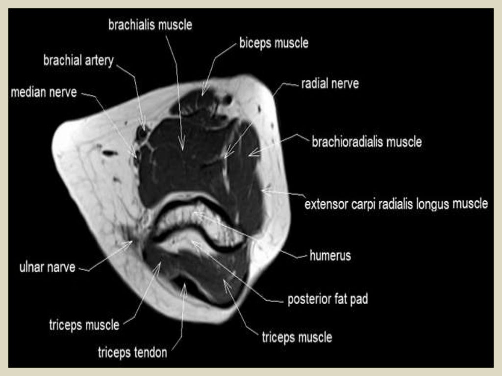 Presentation1.pptx, radiological anatomy of the arm and forearm.