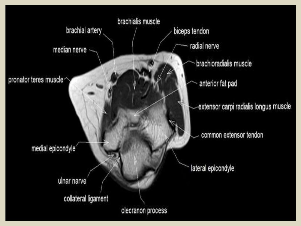 Presentation1.pptx, radiological anatomy of the arm and forearm.