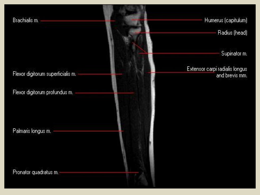 Presentation1.pptx, radiological anatomy of the arm and forearm.