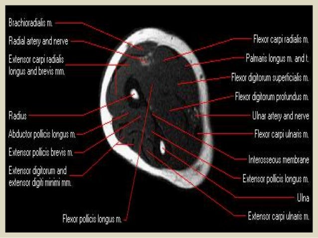 Presentation1.pptx, radiological anatomy of the arm and forearm.