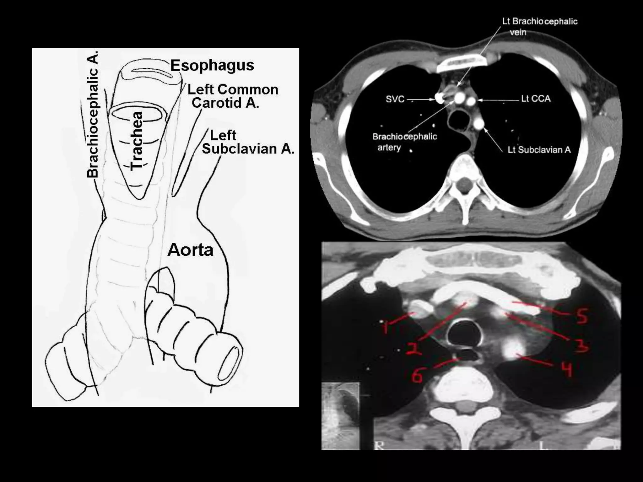 Complex Aortic Arch Surgery | PPTX