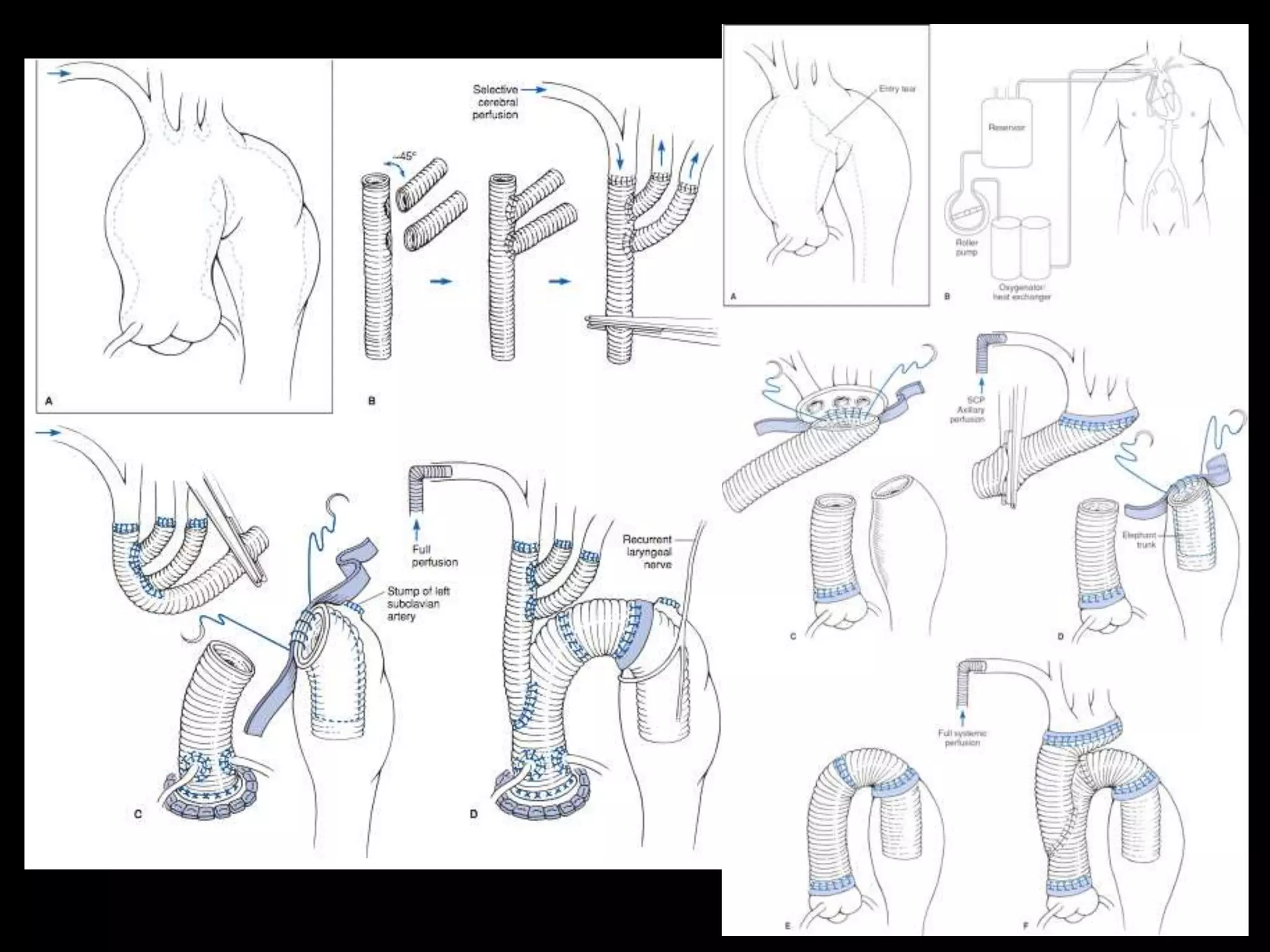 Complex Aortic Arch Surgery | PPTX