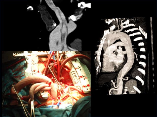 Complex Aortic Arch Surgery | PPTX | Heart and Cardiovascular Diseases ...